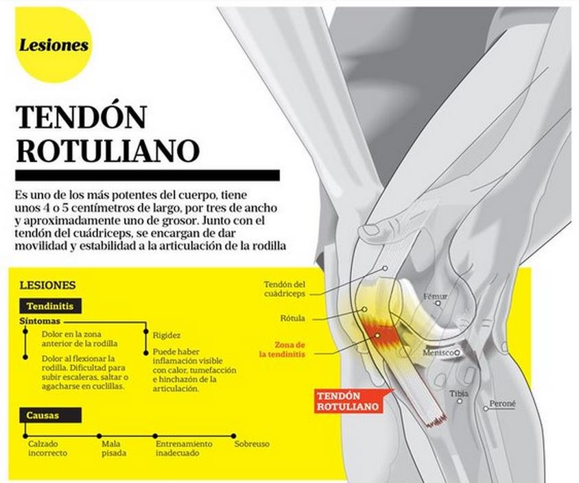 Tendinitis rotuliana – Tu salud es lo primero